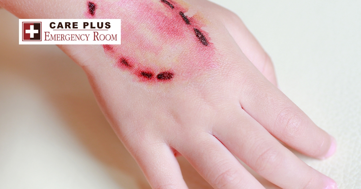 Bite Injuries - Human Bites